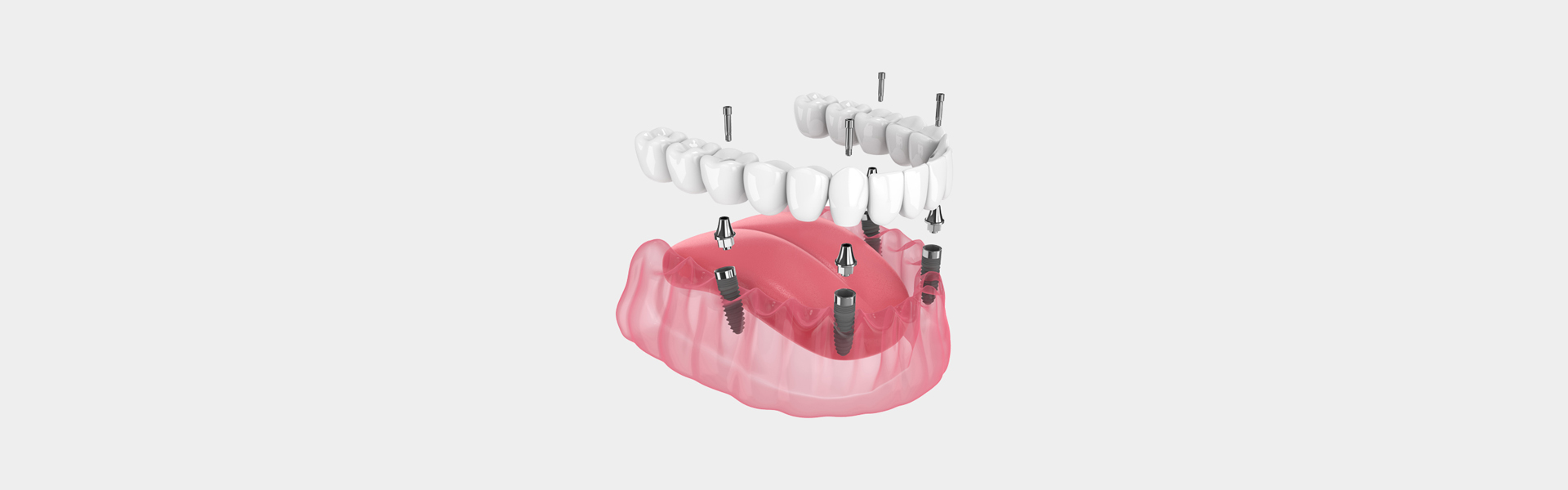 The Evolution of Tooth Replacement: Exploring All-on-4® Dental Implants